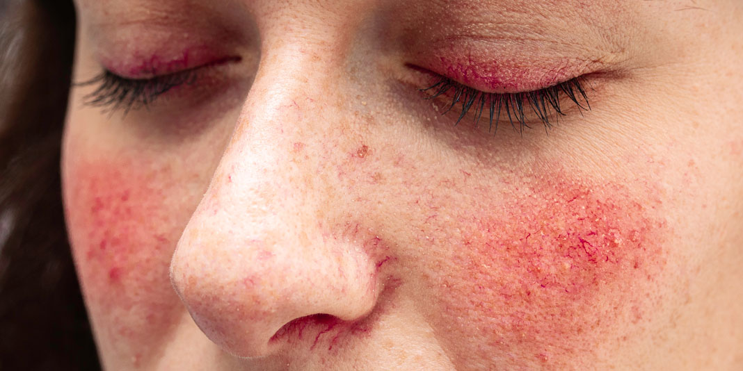 Four Tips To Get Rid Of Facial Redness YouBeauty Four Tips To Get Rid Of Facial Redness YouBeauty